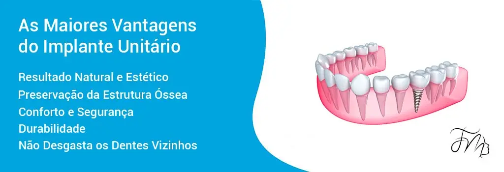 Implante Unitário em Blumenau? Conheça 5 Maiores Vantagens